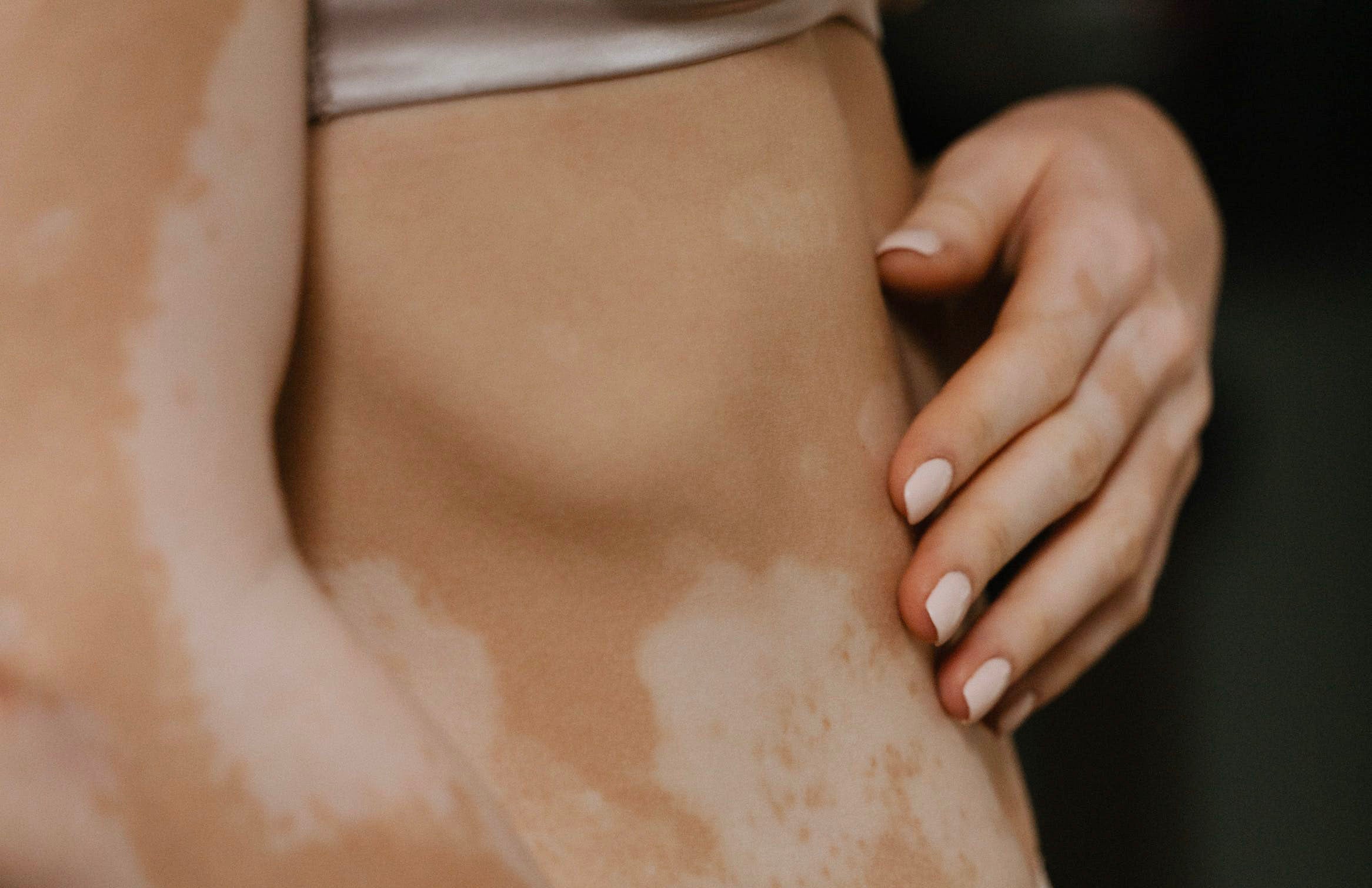 Qu’est-ce que le SOPK? Signes, causes et prise en charge du syndrome d ...
